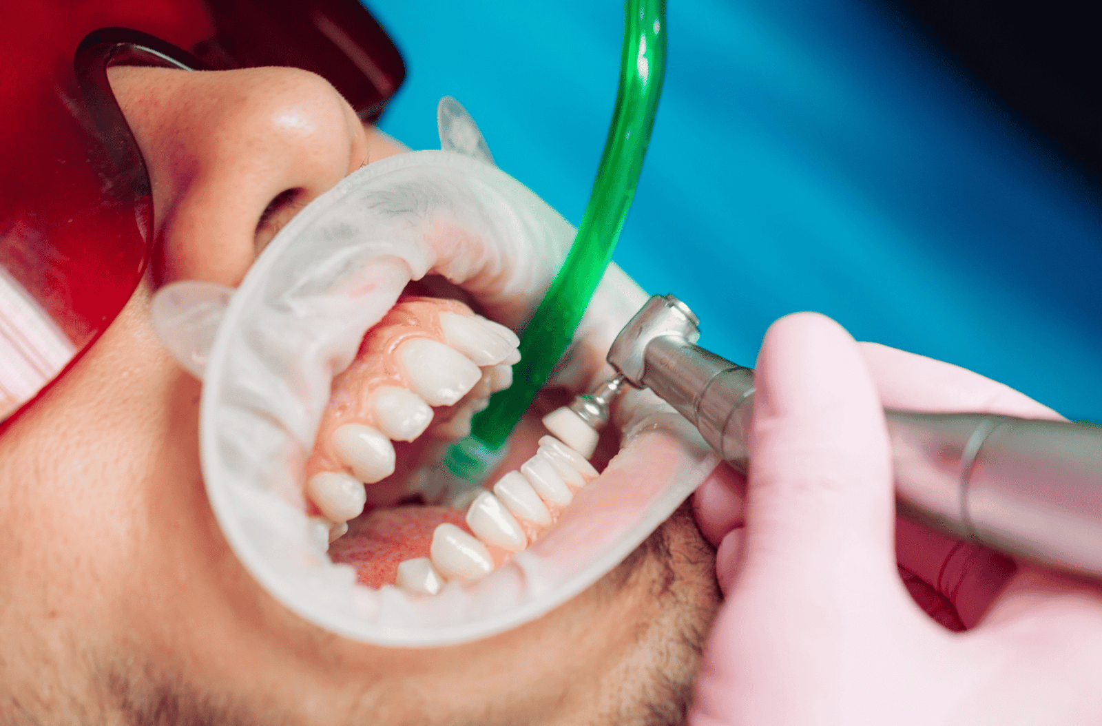 Why Teeth Cleanings Are Important Parkway Dental